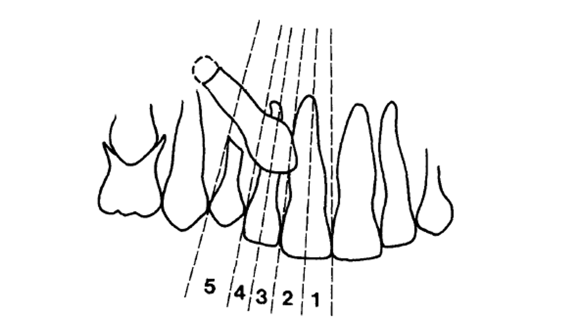 canino – Ortodontia Mazzieiro Blog