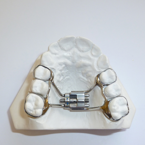 disjunção maxilar – Ortodontia Mazzieiro Blog