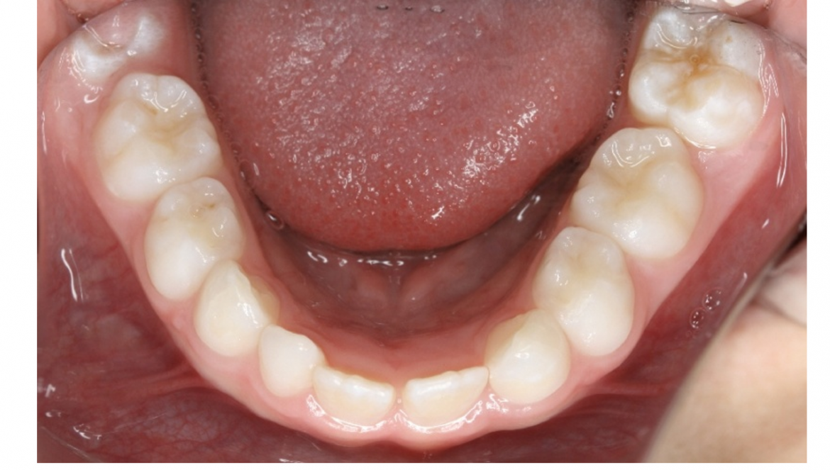 Arco lingual: simples e eficiente no gerenciamento de espaços ...