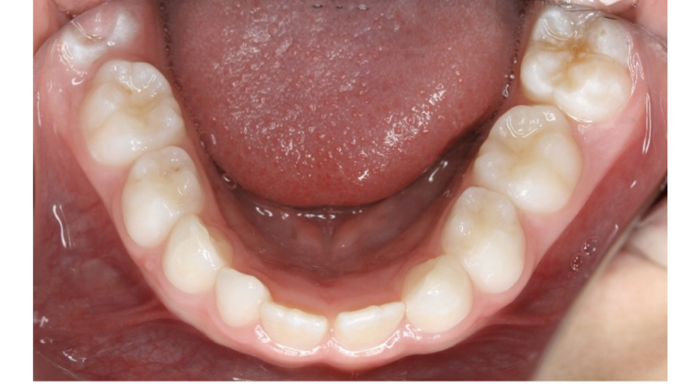 Arco lingual: simples e eficiente no gerenciamento de espaços ...