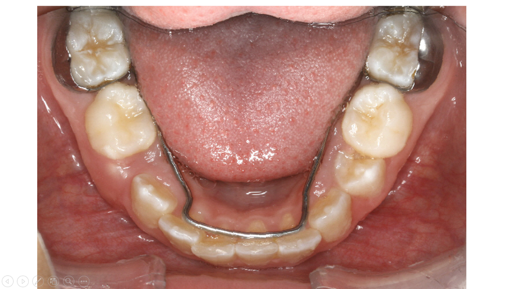 Arco lingual: simples e eficiente no gerenciamento de espaços ...