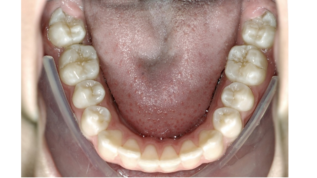 Arco lingual: simples e eficiente no gerenciamento de espaços ...