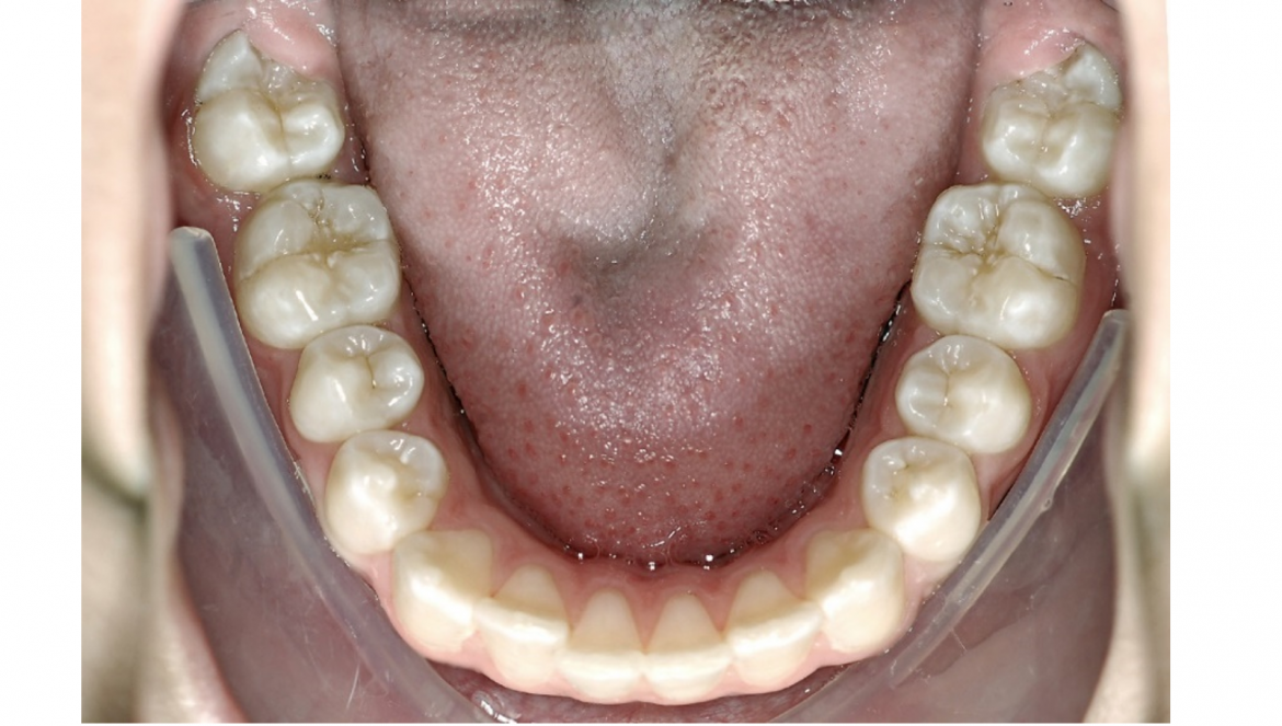 Arco lingual: simples e eficiente no gerenciamento de espaços ...