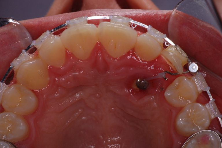 canino – Ortodontia Mazzieiro Blog