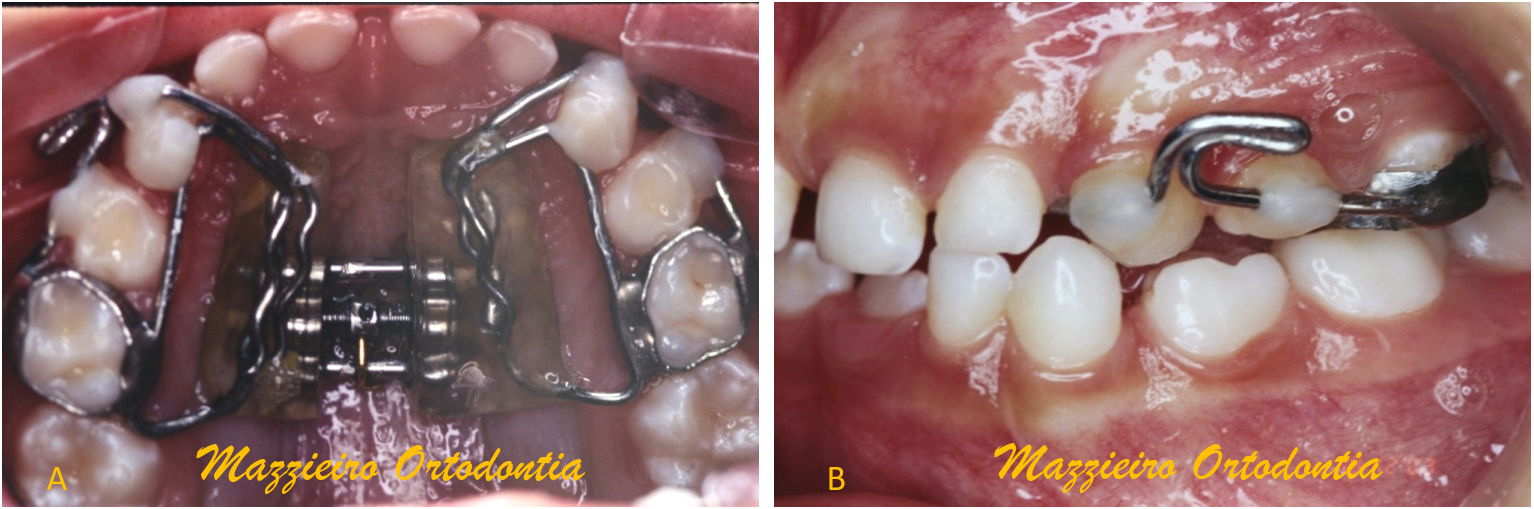 mecânica ortodôntica – Ortodontia Mazzieiro Blog