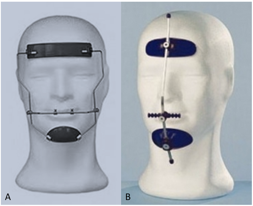 Protocolo clínico para interceptação de mordida cruzada anterior ...