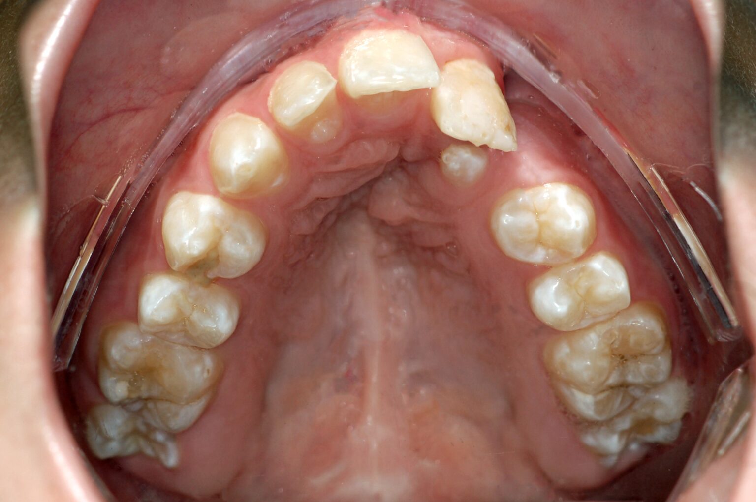 Tratamentos Para Osteíte Alveolar - RETOEDU